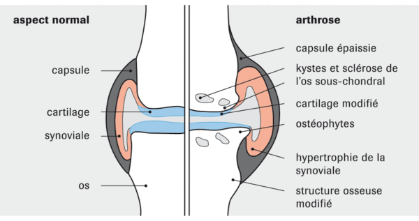 Arthritis / Osteoarthritis - Kinesis Center